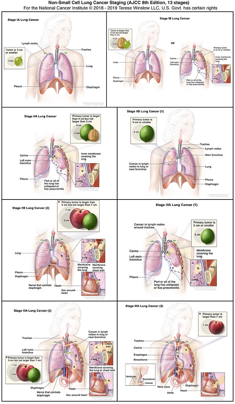 Lung Cancer Staging Diagram